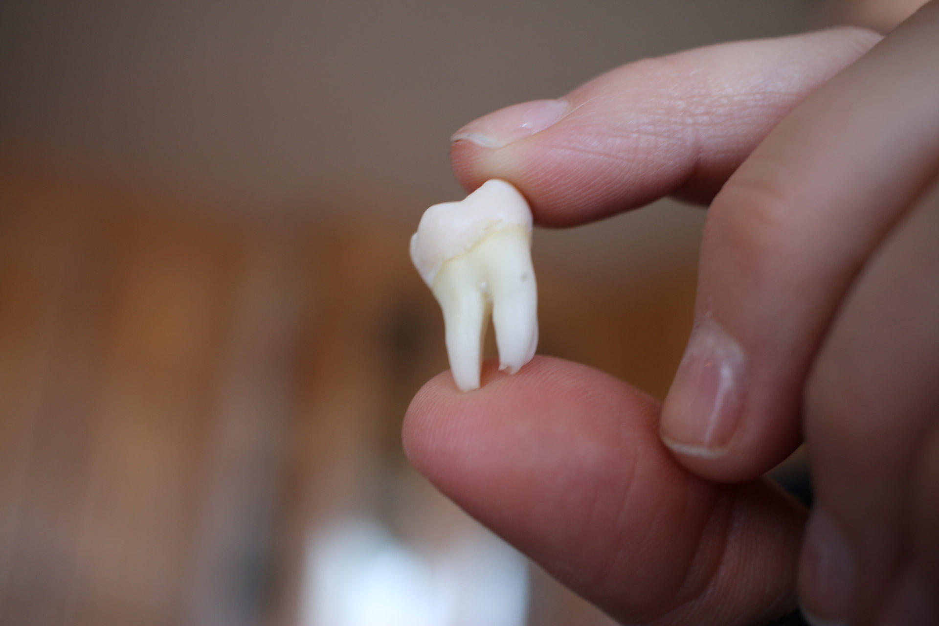 Health Hint! –Wisdom tooth impaction and early detection signs ...